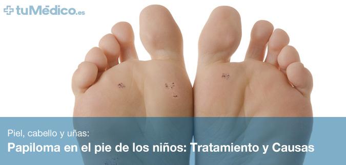 Papiloma en el pie de los niños: Tratamiento y Causas